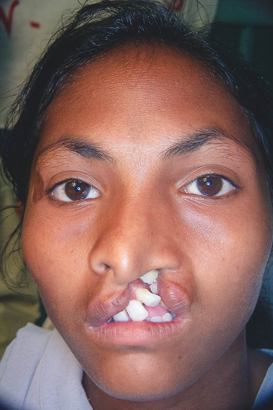 26 Celebrities With Cleft Lips Cleft Lip And Palate C - vrogue.co 26 Celebrities With Cleft Lips Cleft Lip And Palate C - vrogue.co